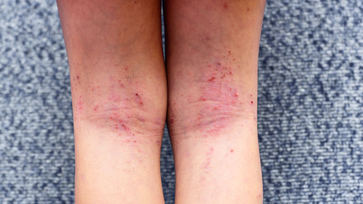 Sores On Body From Drugs