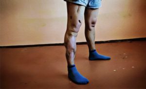 What is Krokodil, What Are Its Effects, What Are Common Uses